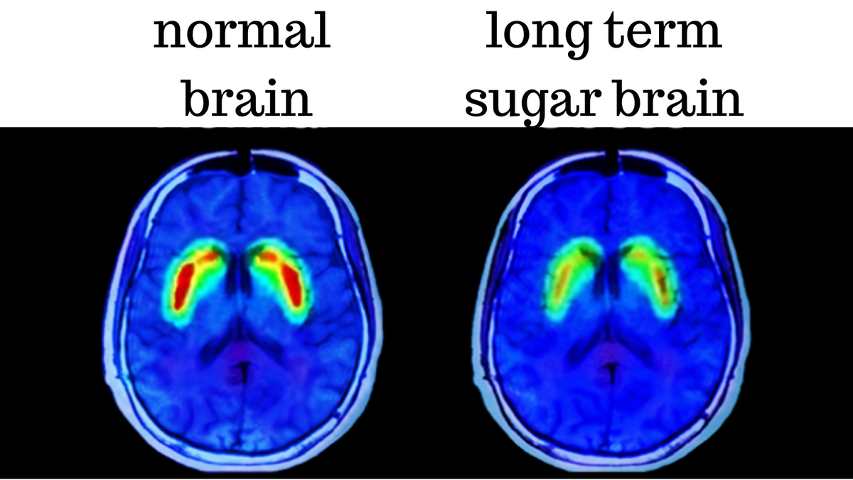 🧠 HOW SUGAR AFFECTS YOUR BRAIN 🧠 – Fitbakes®
